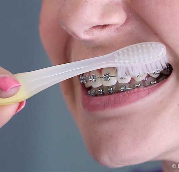 Brushing & Flossing with Braces | Family Orthodontics of Annapolis ...
